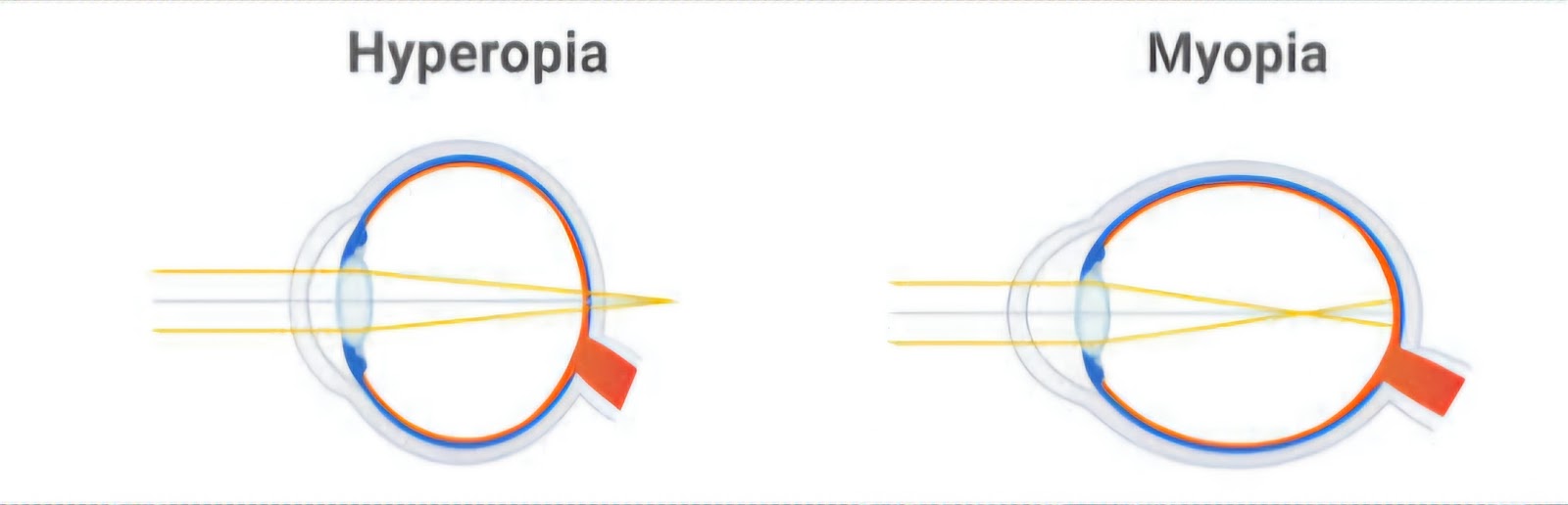 Myopia vs hyperopia: What's the difference?